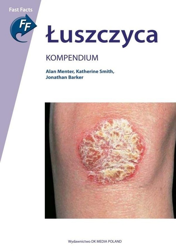 Łuszczyca Kompendium - Alan Menter - Książka | Gandalf.com.pl